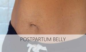 Postpartum Belly: How Long Before My Belly Is Normal Again? - Urban Mamaz